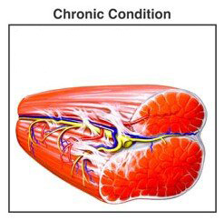 Muscle-Chronic-Condition - The Muscle Medics